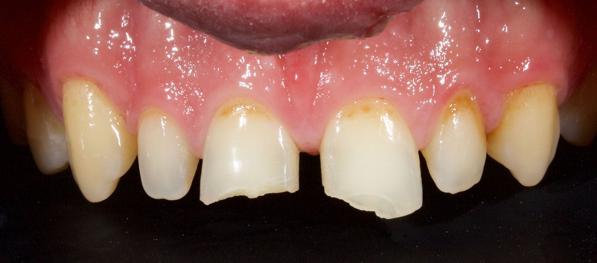 Post trauma class IV resin on upper central incisors | The Restorative ...