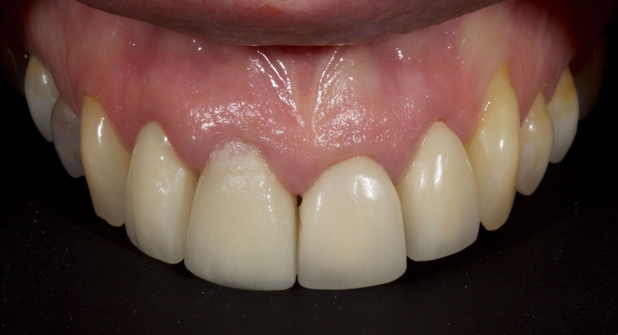 Vertical preparation of upper incisors | The Restorative Programme