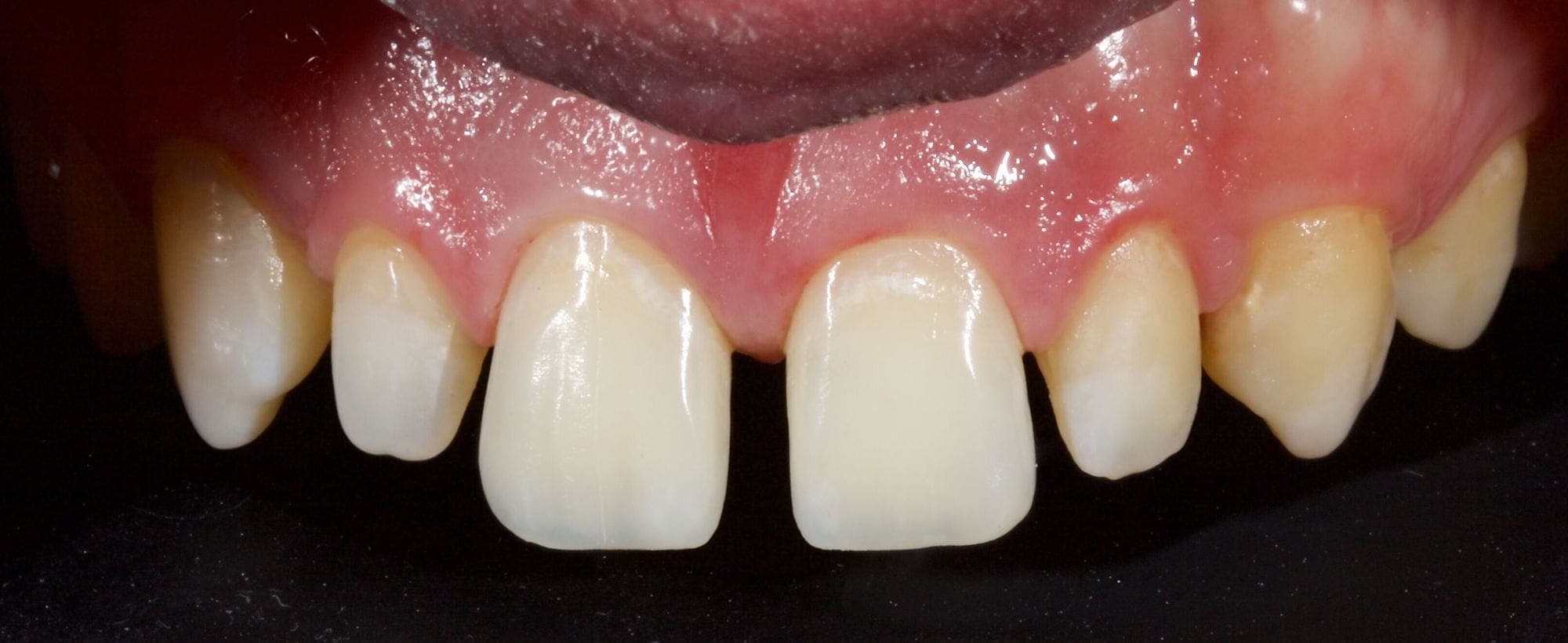 Post trauma class IV resin on upper central incisors | The Restorative ...