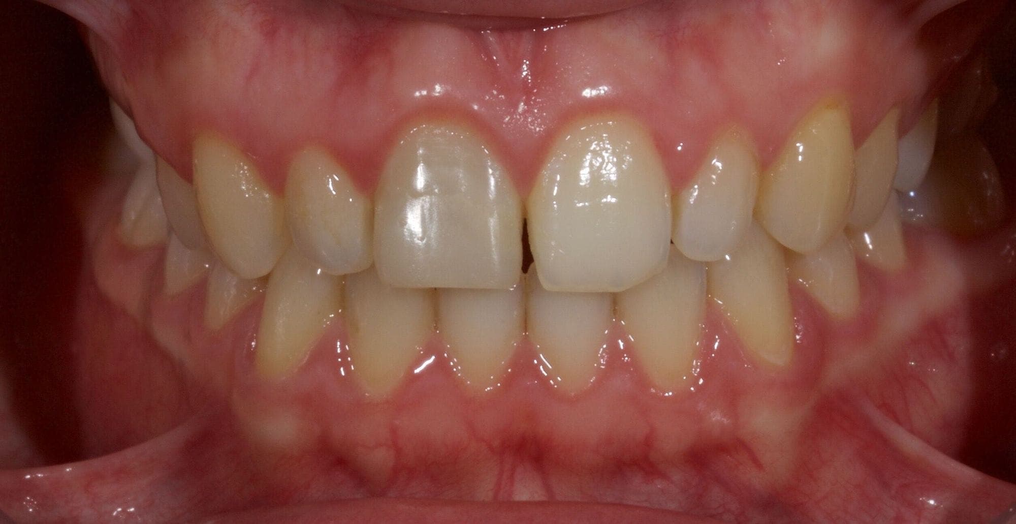 Replacement of class IV restoration | The Restorative Programme