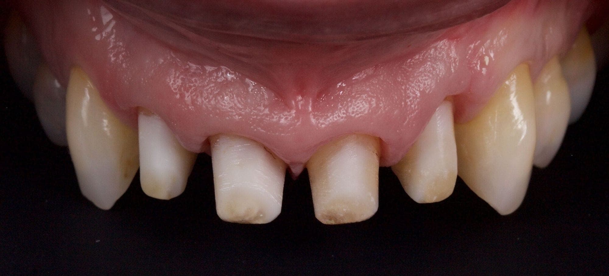 Vertical preparation of upper incisors | The Restorative Programme