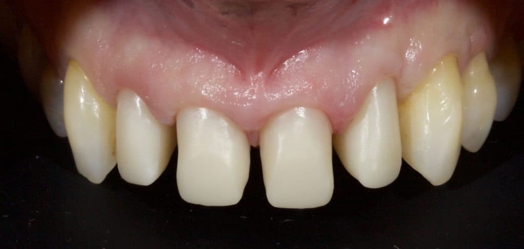 Vertical preparation of upper incisors | The Restorative Programme