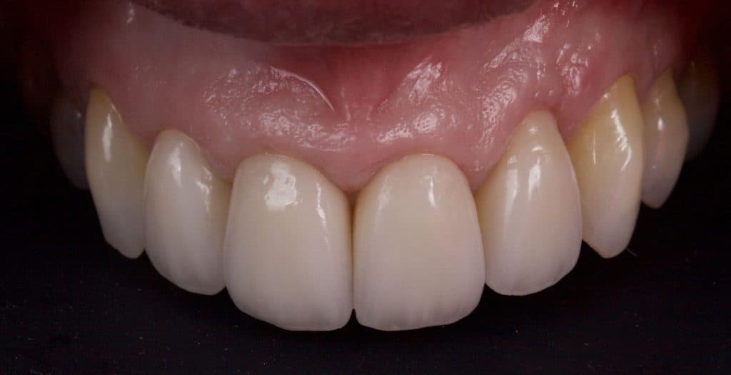 Vertical preparation of upper incisors | The Restorative Programme