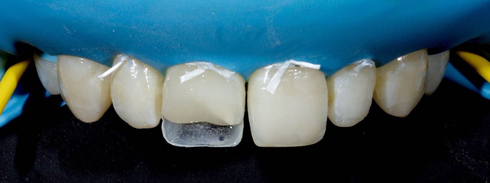 Replacement of class IV restoration | The Restorative Programme