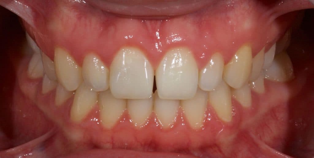 Replacement of class IV restoration | The Restorative Programme