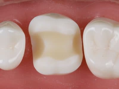 The Onlay Prep - A Series of Three Webinars With Jason Smithson. | The ...